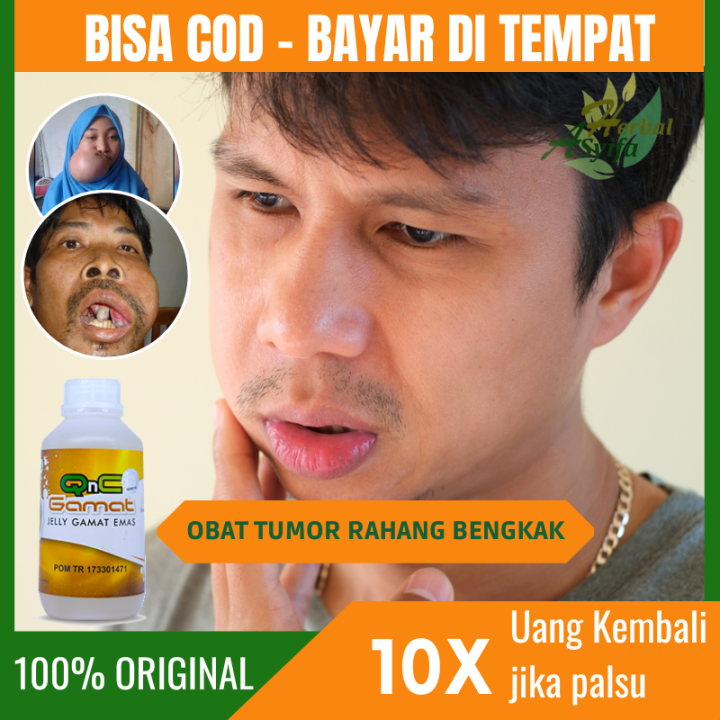 Obat Tumor Rahang Bengkak, Benjolan Di Rahang, Benjolan Di Gusi Dalam ...