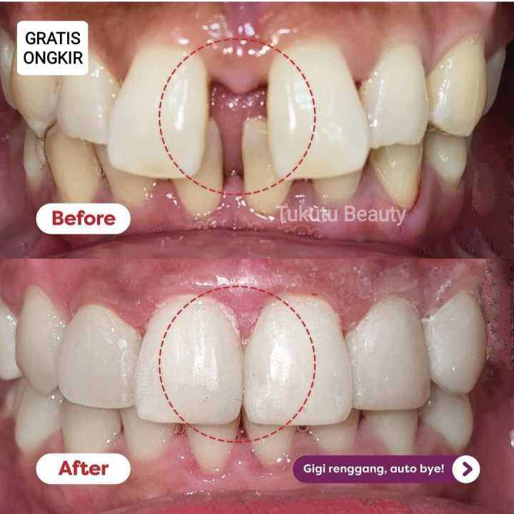 Tahap 2 Alat Perapi Gigi Karet Pelurus Gigi Perata Gigi Behel Gigi ...