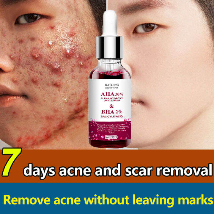 100% Original Acne Pimples Remover Cream Pimple Remover Acne Cream ...