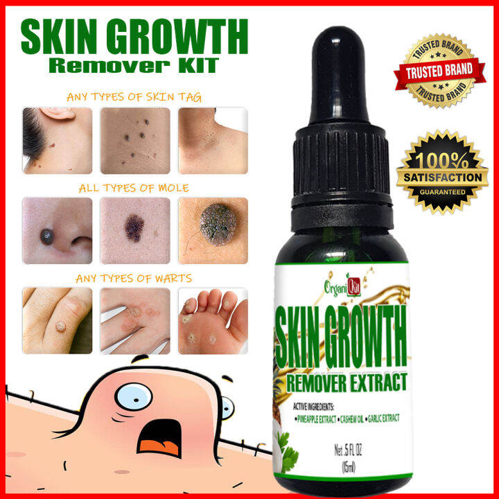 BEST SELLER! SKIN GROWTH REMOVER EXTARCT / Nunal remover / Unwanted ...