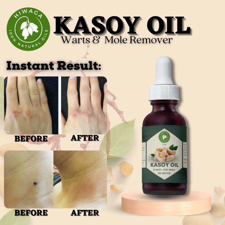 ️[HIWAGA] Authentic Pure Kasoy Oil(15ml) ️ Super Effective in Removing ...