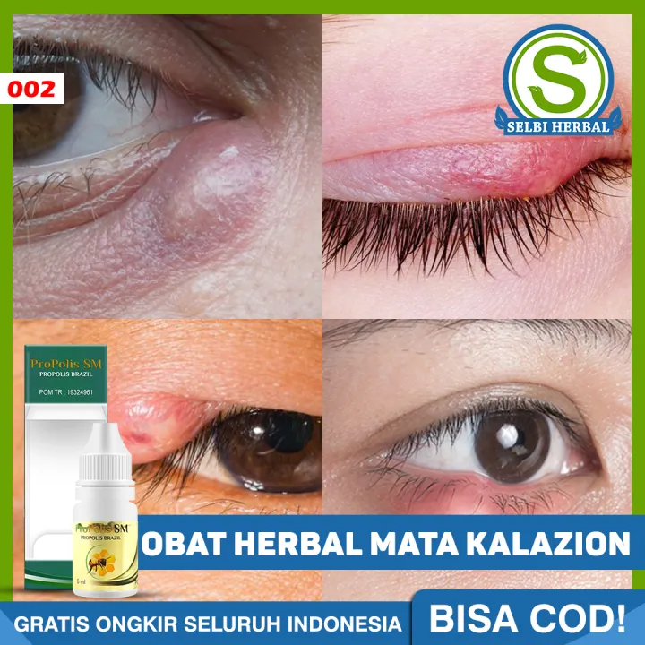 Obat Herbal Mata Kalazion - Benjolan di Kelopak Mata - Mata Bintit ...