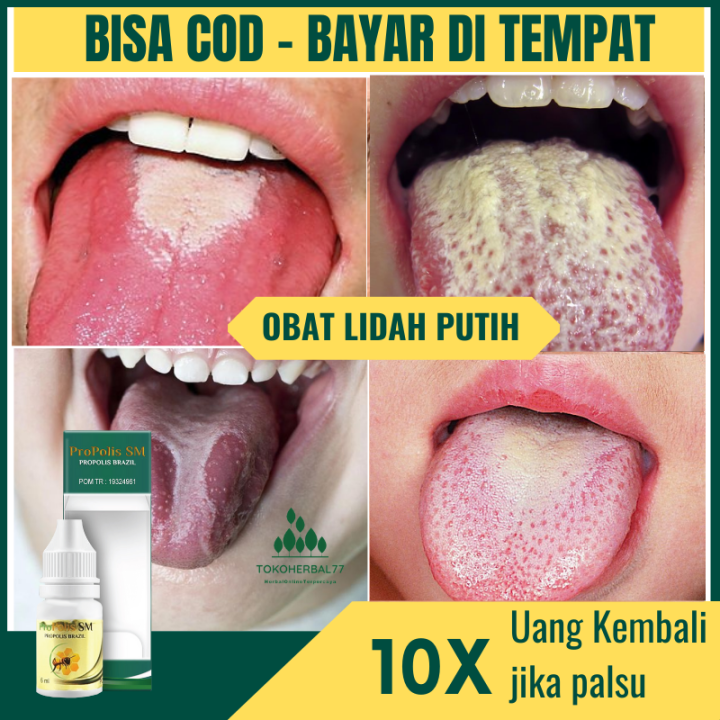 Obat Untuk Lidah Putih, Penghilang Kandidiasis Mulut, Infeksi Jamur ...