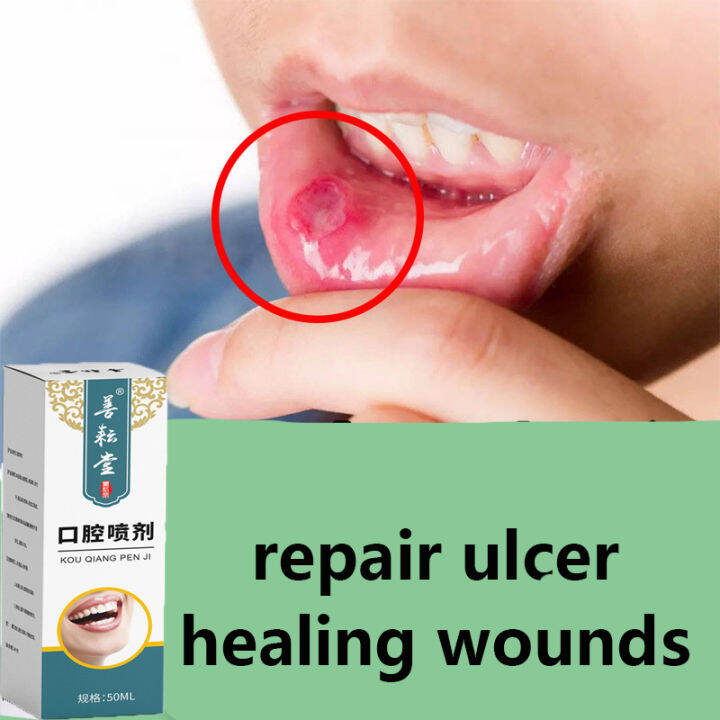 🔥Effect Quickly 🔥canker mouth sore solution 50ml treatment mouth sore ...