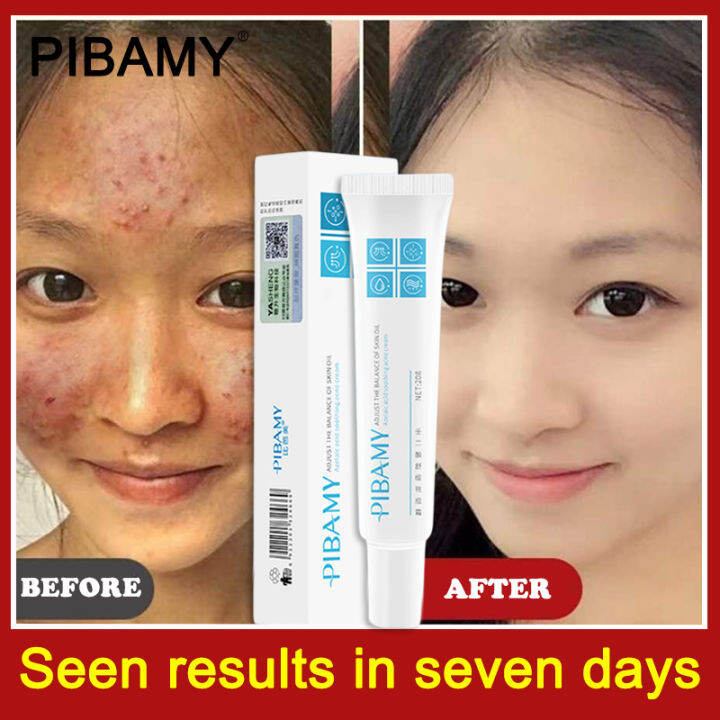 PIBAMY pimples and acne remover Marks Improve puberty acne, keep face ...