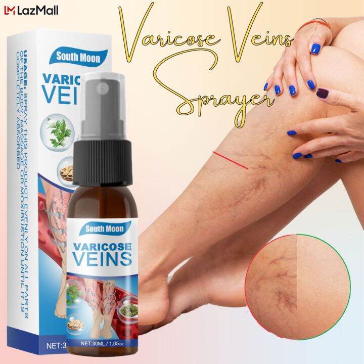 Varicose Vein Spray 30ml Smoothes Bulging Blood Vessels Varicose Veins ...