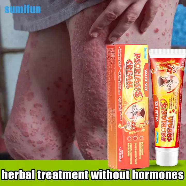 【COD】【Sumifun】Eczema Treatment Cream gamot sa kati kati sa balat buni ...