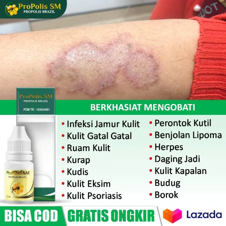 Obat Gatal Dan Jamur Pada Kulit, Infeksi Jamur Kulit, Jamur ...