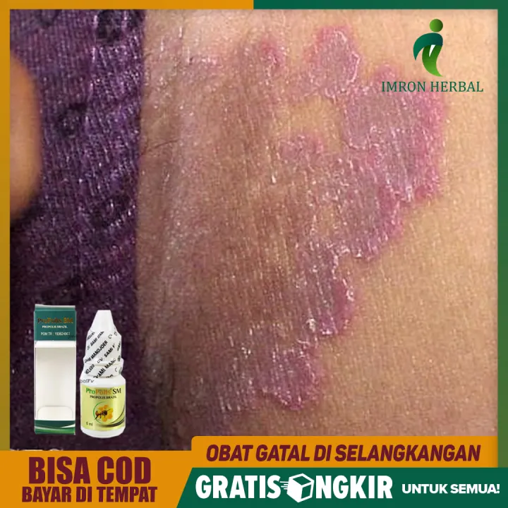 Obat Gatal di Selangkangan - Infeksi Jamur - Penghilang Jampes - Tinea ...