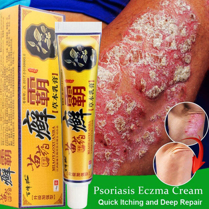 【Quick Itching Relief】Sumifun Eczema Treatment Cream Atoderma Cream ...
