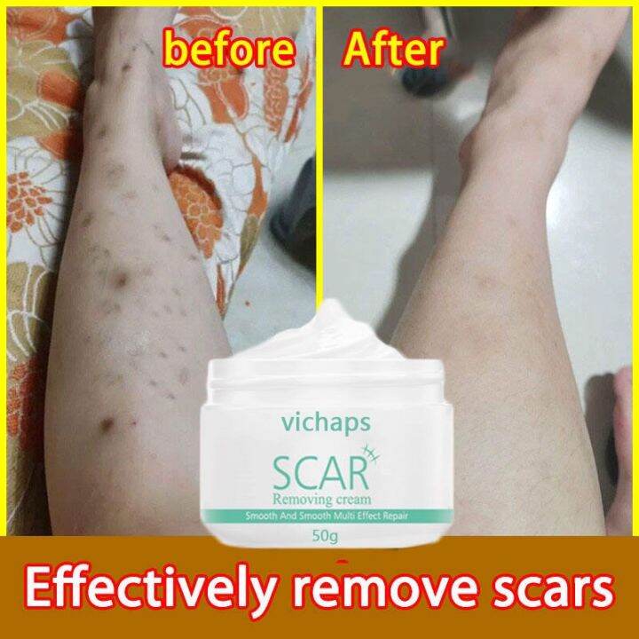Scar Remover for Old Scar on Leg Stretch Mark Remover Acne Scar Remover ...