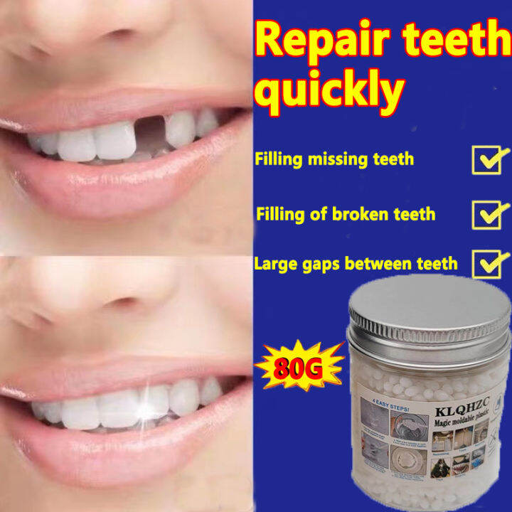 【Fast filling】DIY Tooth Repair Kit Temporary Tooth Repair kit 80g ...