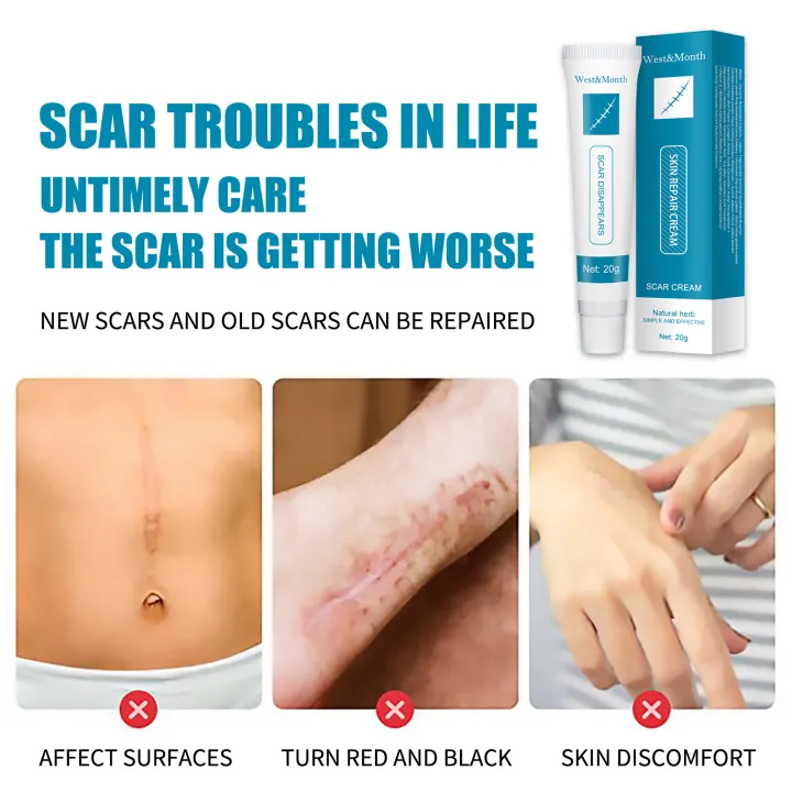 100% effective Scar removal cream Scar remover Acne Scar Removal Cream ...