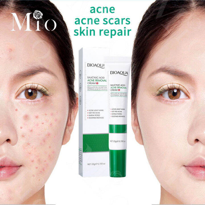 BIOAOUA Salicylic Acid Acne Remove Acid Acne Cream 20g Blackhead ...