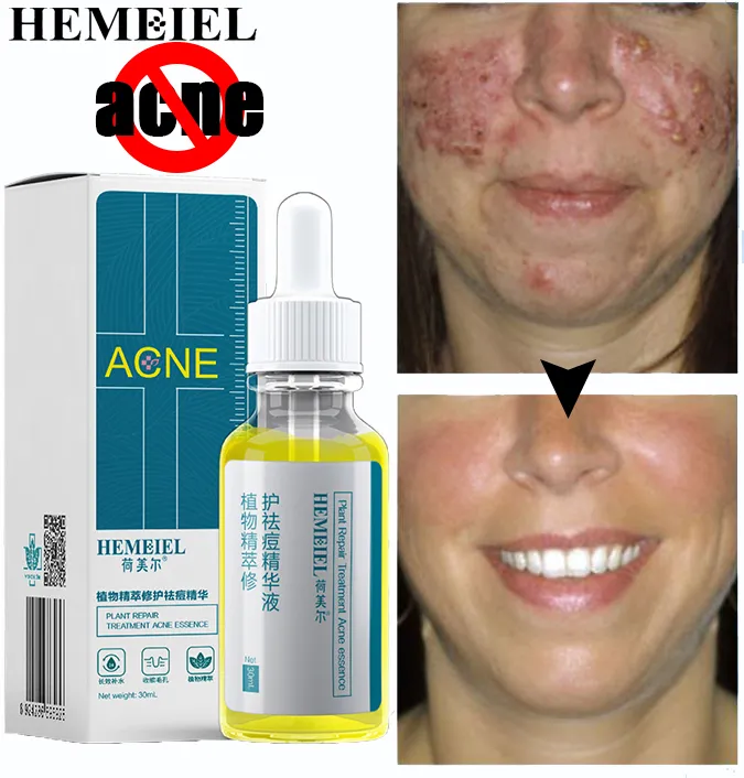 HEMEIEL pimples acne remover best seller acne care serum pang tanggal ... HEMEIEL pimples acne remover best seller acne care serum pang tanggal ...