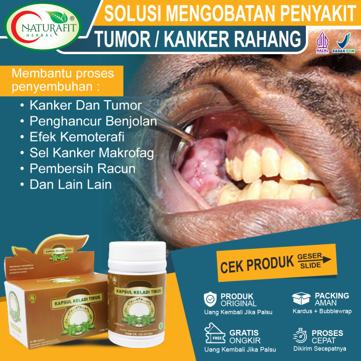 Obat Tumor Rahang Paling Ampuh, Benjolan di Rahang Mulut, Kanker Rahang ...