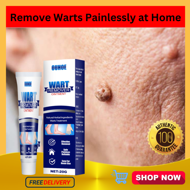 🔥PROVEN EFFECTIVE🔥 20g PREMIUM AND AUTHENTIC Warts Remover MABISANG ...