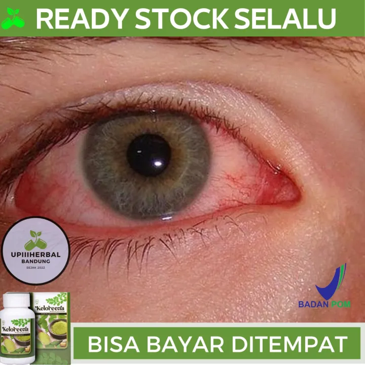 Obat Radang Mata, Obat Radang Mata, Obat Mata Sakit, Obat Mata Pedih ...