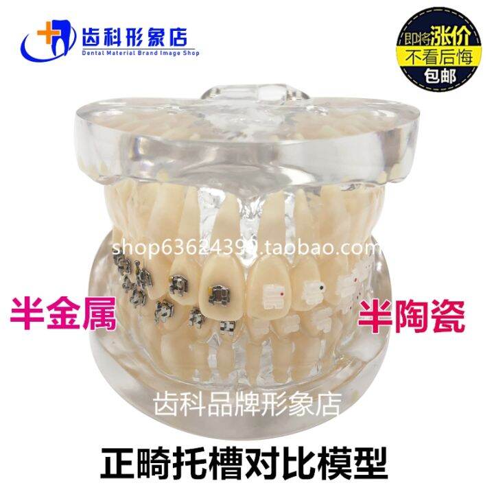 Dental model self-locking braces orthodontic half mouth metal ceramic ...