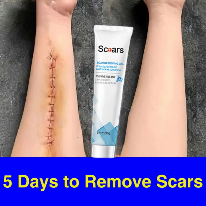 Scar Remover Gel Cream Fade Acne Scars Stretch Marks Repair and Heavy ...