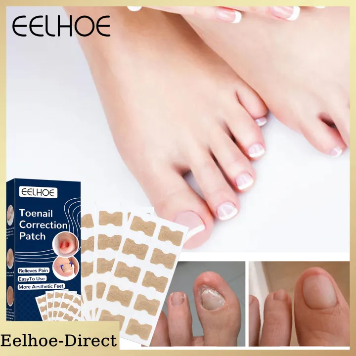 Eelhoe Toenail Correction Stickers Manicure Orthopedic Stickers ...