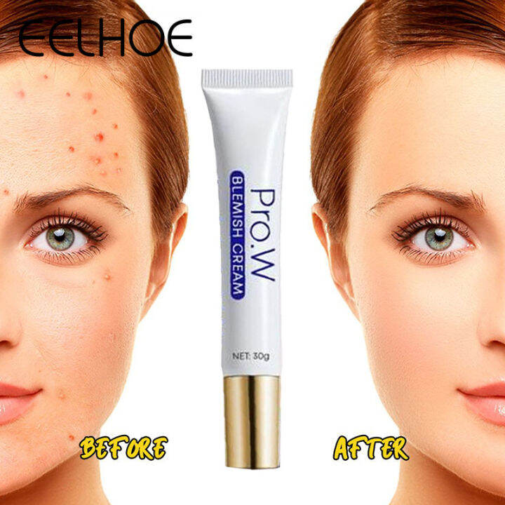 EELHOE Acne Treatment Cream Anti Acne Face Cream Pimple Removal Spots Oil Control Shrink Pores ...