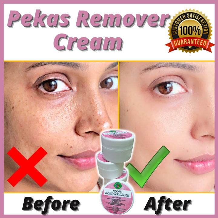 Melasma and Pekas Remover Original Cream with SPF 45 | Lazada PH