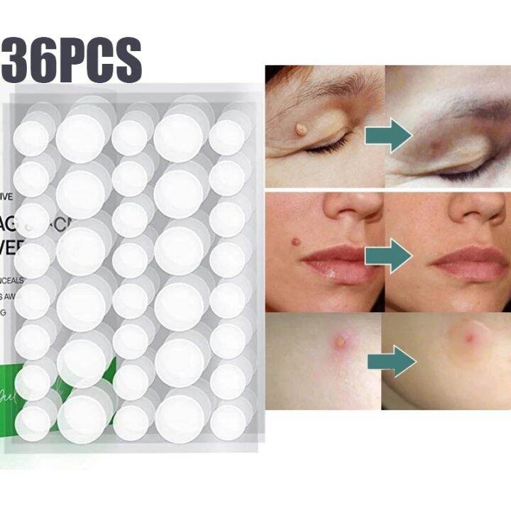 【Jealous Girl】36Pcs Skin Tag Remover Patch Pimple Wart Treatment Cream ...