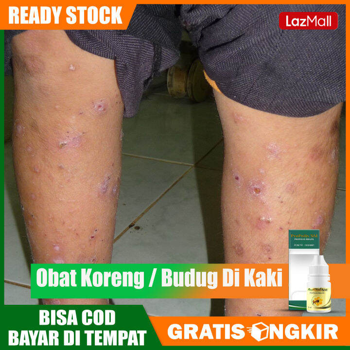 Obat Koreng Di Kaki, Koreng Bernanah, Koreng Menahun, Bekas Koreng ...