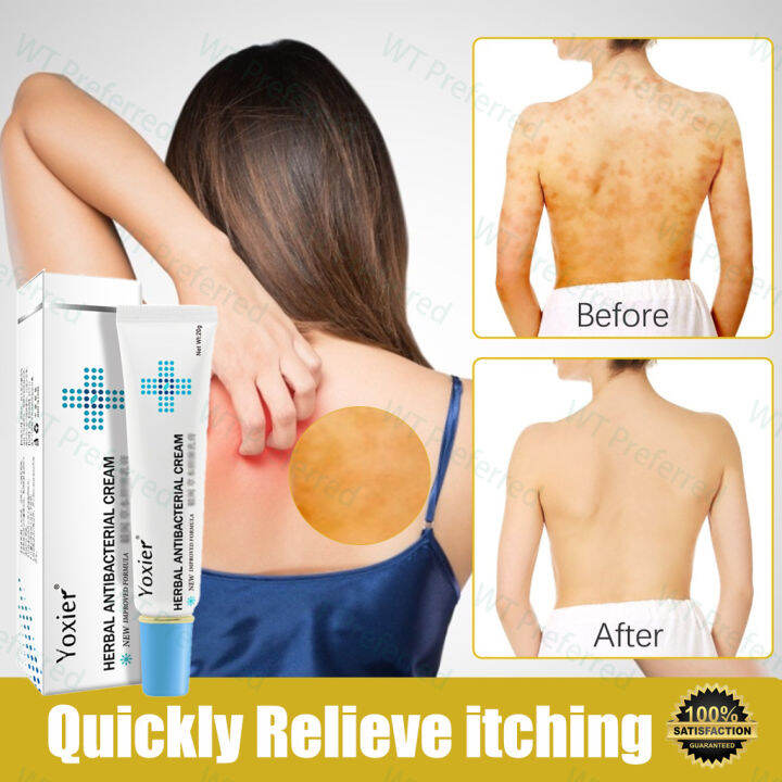 100% Effective Guarantee Safe Yoxier Natural Herbal Antibacterial Cream ...