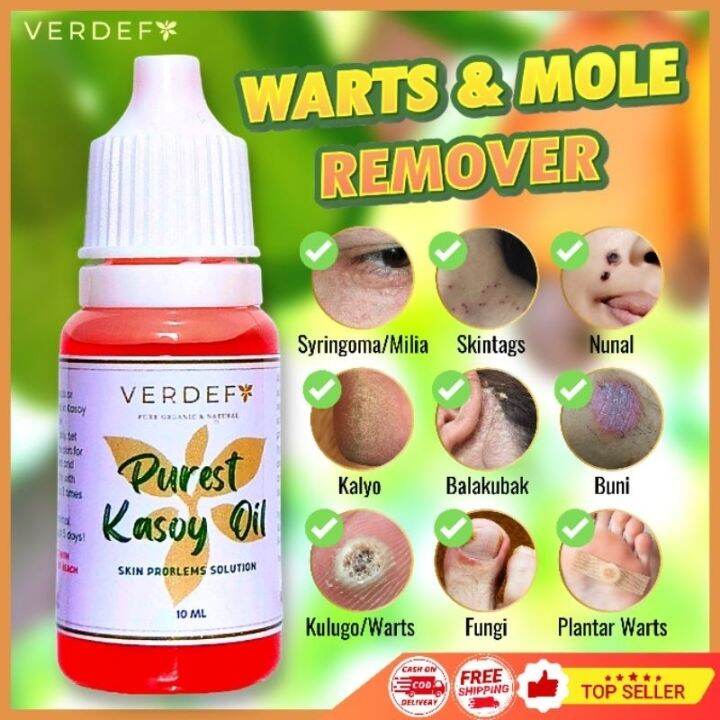 Original Kasoy Oil Effective Remover Warts Nunal Skin Tag Kulugo Kalyo ...