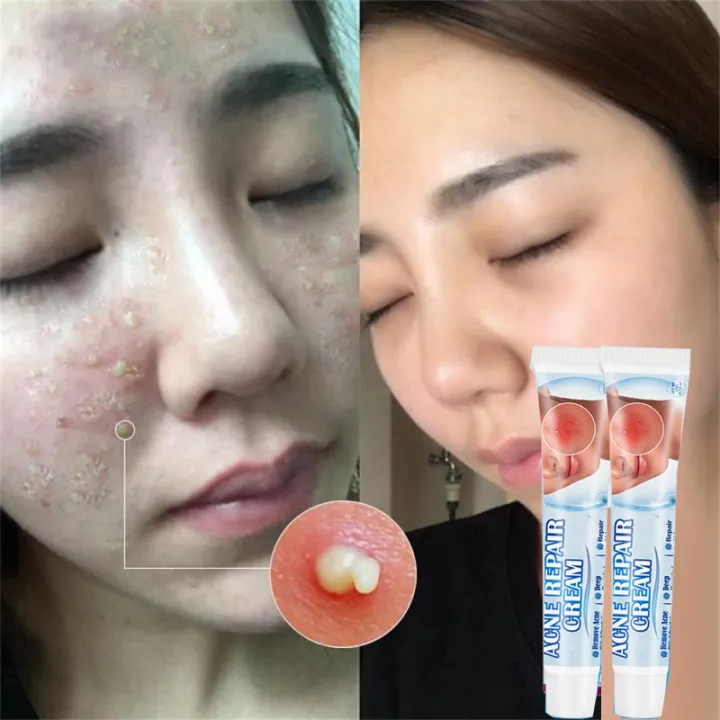 Remove Pimples Quickly Acne gel scar remover Pimple Remover Acne Cream Fades Acne Marks Repairs ...
