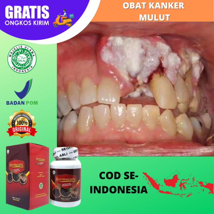 Obat Kanker Mulut, Herbal Untuk Kangker Rahang Kronis, Radang ...