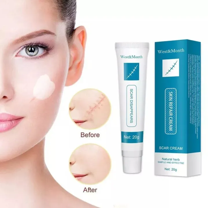 Remove Stretch Mark Scar Scar Removal Cream Old Scar Scar Remover Cream ...