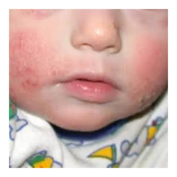 2pcs set Skin Rashes galis Rushes Removal 100% Organic For Fight ...