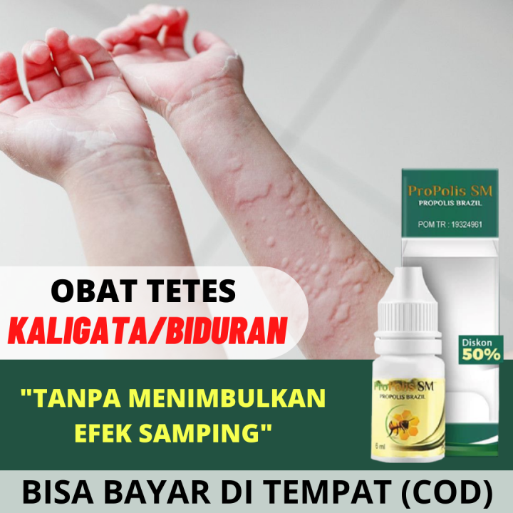 Obat Alami Penghilang Kaligata Atau Biduran - Obat Kaligata - Biduran ...