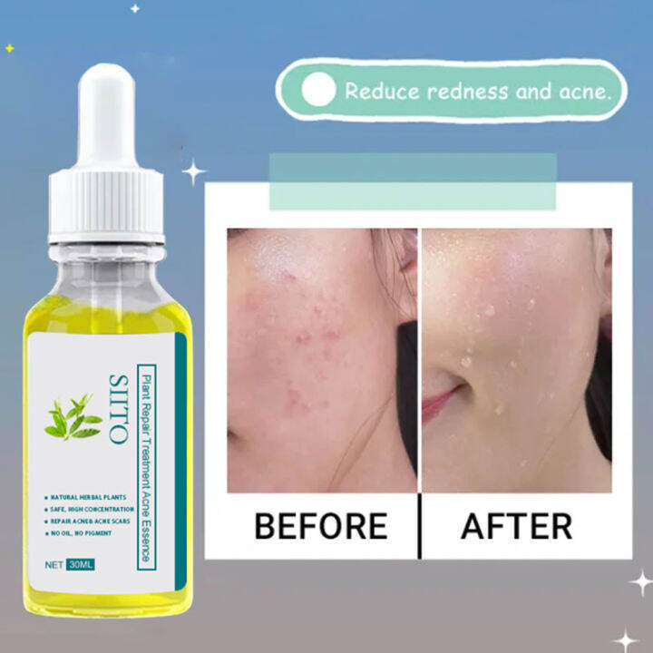 Pimples & Acne Remover Pimple Eraser Serum 30ml | Lazada PH