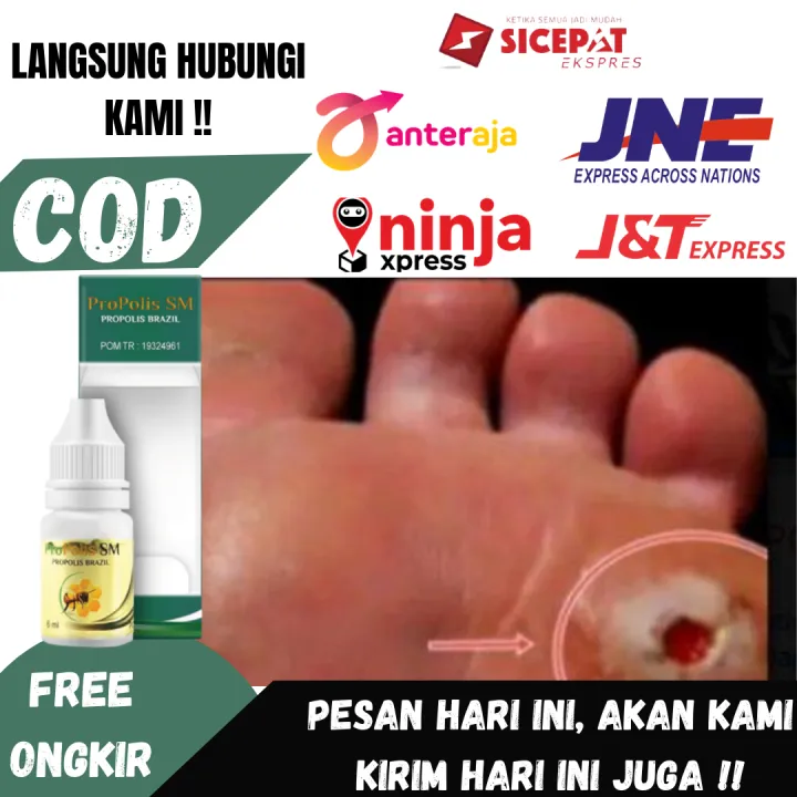 Obat Bubul di Telapak Kaki Manusia, Penghilang Mata Ikan, Obat ...