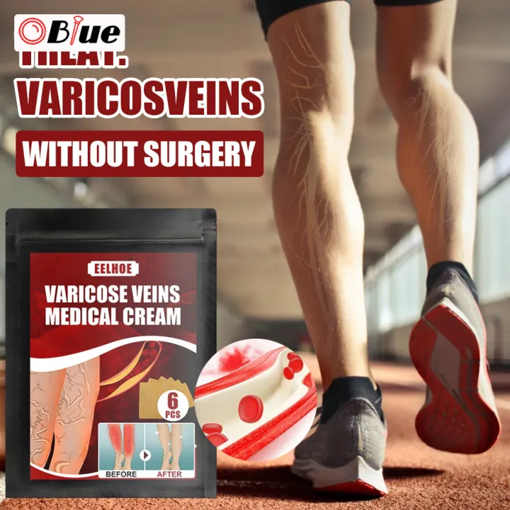 OBlue Varicose Veins Patch For Phlebitis Angiitis Inflammation ...
