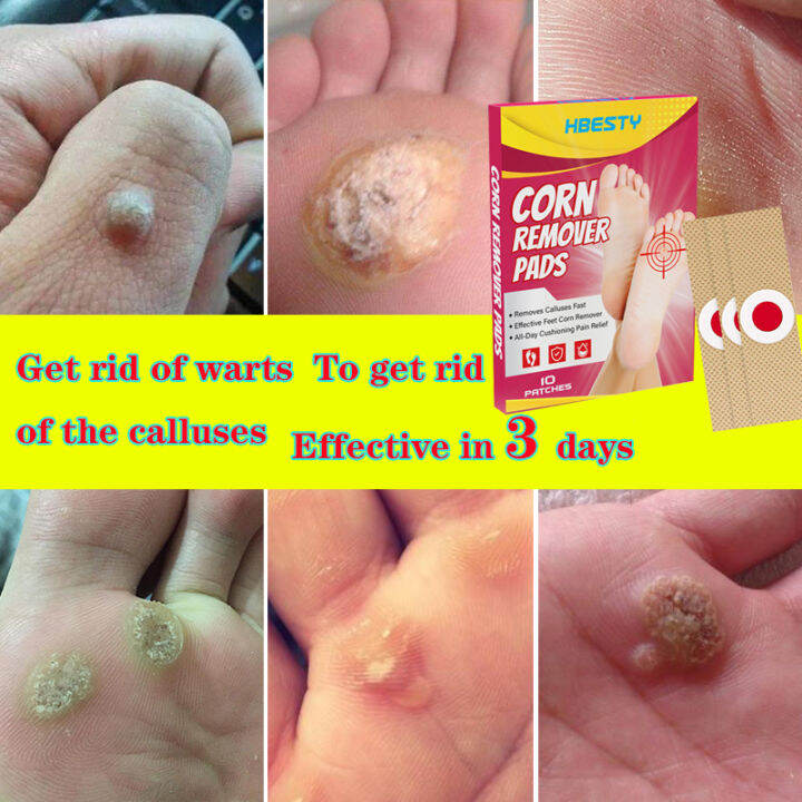 10Pcs Feet Corns/ Warts Removal Patch Pain Relief Remover Feet Callus ...