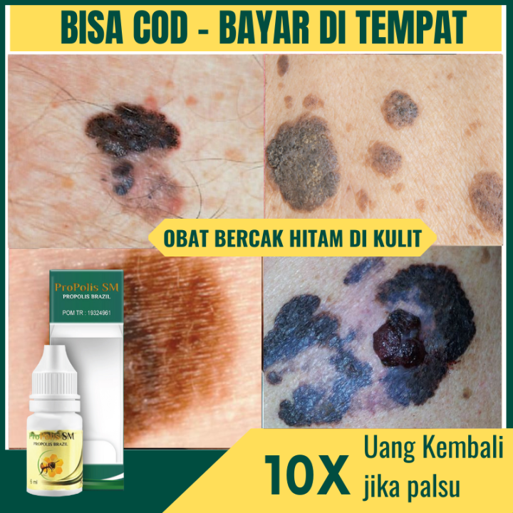 Obat Bercak Hitam di Kulit, Benjolan Hitam di Wajah, Kanker Kulit ...