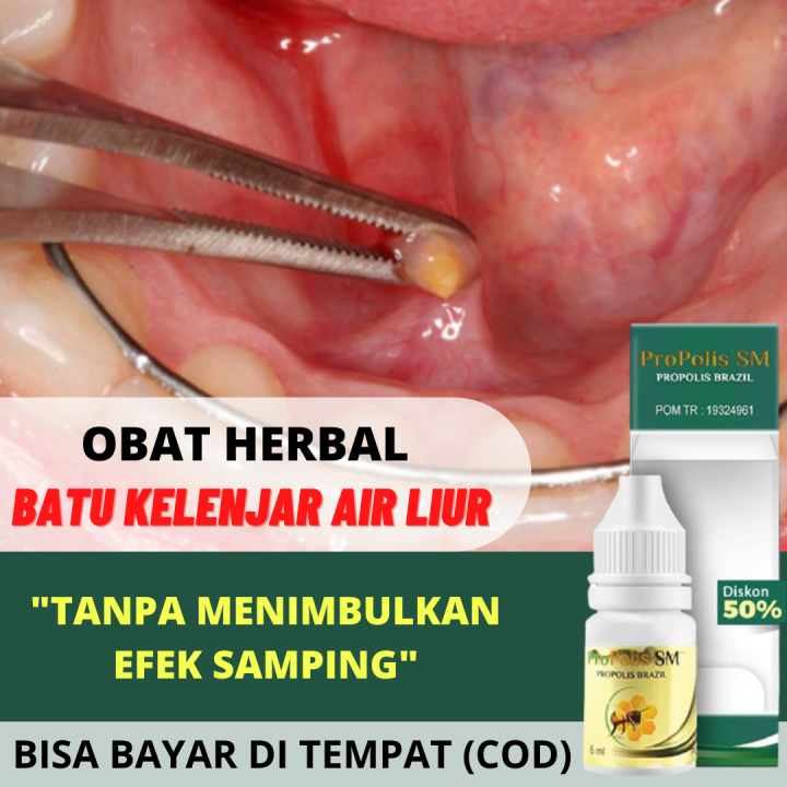 Obat Kelenjar Batu Air Liur - Obat Batu Kelenjar Ludah, Obat Benjolan ...
