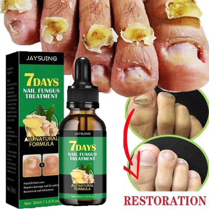 【Authentic Authorization】7DAYS Nail Fungus Treatment Essence Serum Anti-Infection Onychomycosis ...