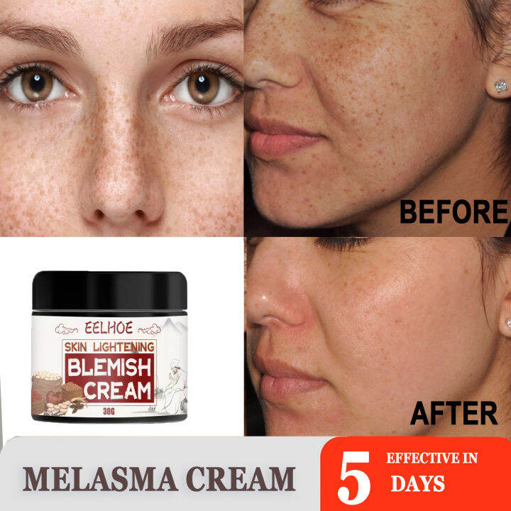 melasma and pekas remover cream original Spots & Blemishes from japan ...