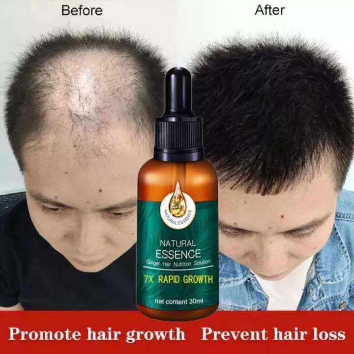 Eelhoe Hair Growth Serum Penumbuh Rambut Wanita Pria Secara Cepat