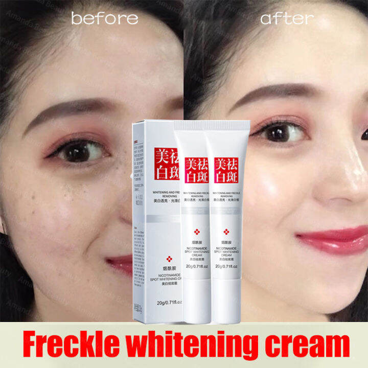 🔥Effective in 5 days🔥 Melasma Freckle removal whitening cream original ...