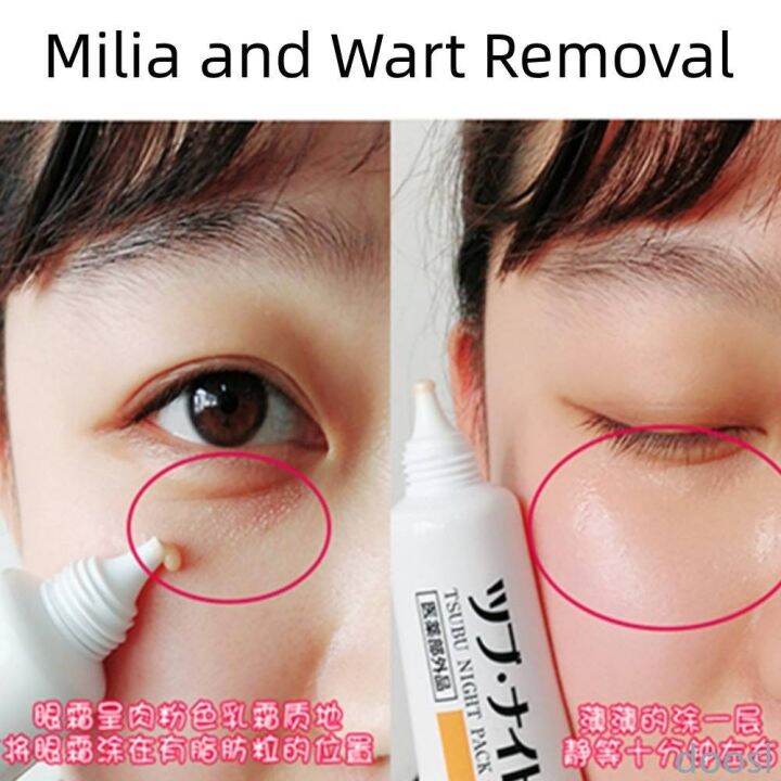 (in stock)Tsubu Night Milia Pack (Oil Bumps) / Wart Remover Cream 30g ...