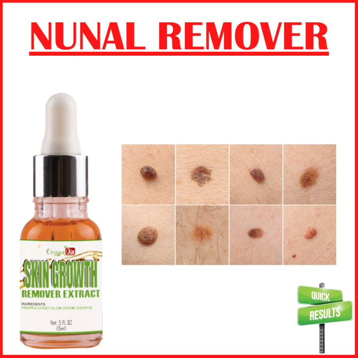 NUNAL REMOVER Skin Growth Remover Extract , nunal removal cream , pantanggal ng nunal na buhay ...