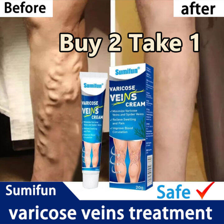 【Buy 2 Take 1，Buy 4 Take 2】Sumifun Varicose vein ointment Red blood ...