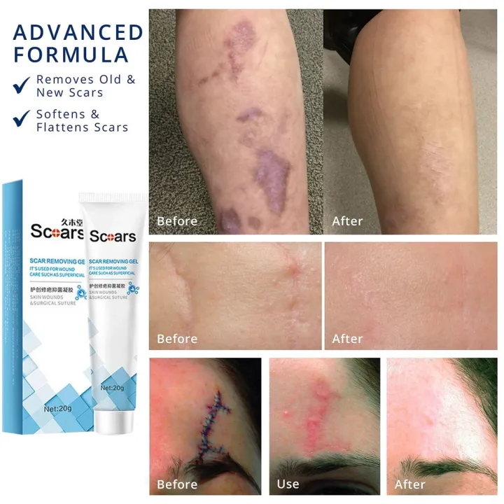 Scar Removal Cream Scars Repair for Skin Face Body Old Scar on Leg ...